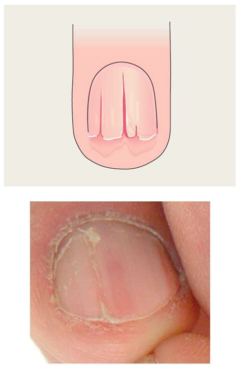 Median Nail Dystrophy