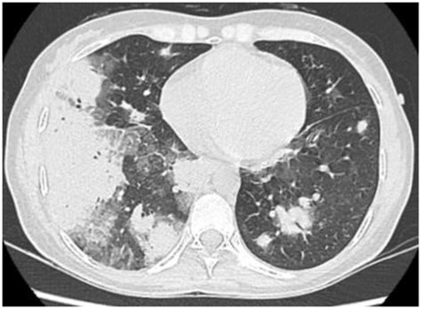 Cholangitis Ct Xanthogranulomatous Cholangitis Mimicking