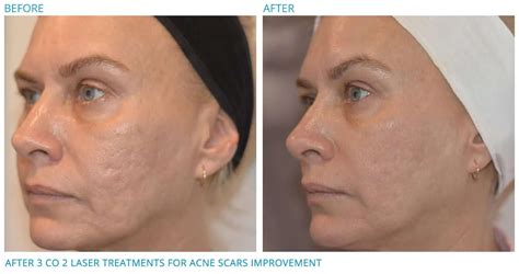 C02re Co2 Fractional Laser Treatment Ixxliq