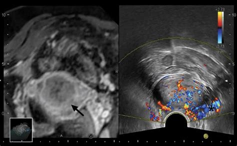 Squamous Cell Carcinoma Ultrasound