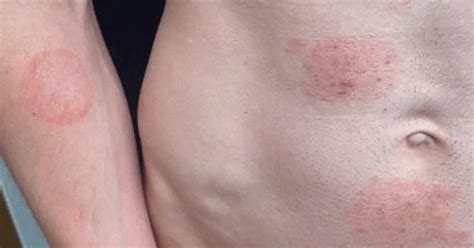 Warning Over Highly Contagious Rare Genital Fungus Spreading Through Sex News Uk Metro News