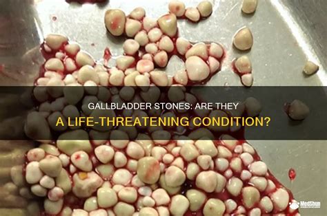 Gallbladder Stones Are They A Life Threatening Condition Medshun