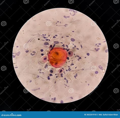 Photomicrograph Of Paps Smear Inflammatory Smear With Vaginal Candidiasis Royalty Free Stock