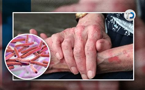 Lepra Síntomas Y Tratamiento Presión Arterial Alta Hipertensión Tlwk
