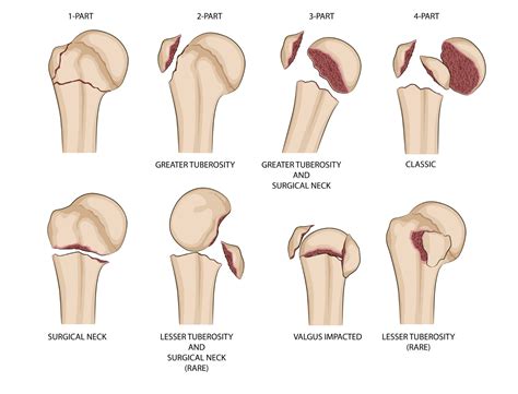 Humerus Bone Fracture Humerus Bone Fracture
