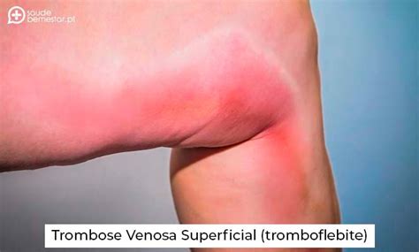 Tromboflebite Gamba