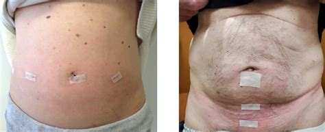Inguinal Hernia Dr Yiannis P Ioannou