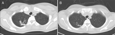 Chest Ct Findings A Chest Ct Shows Ill Defined Patchy Consolidation