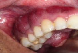Oral Presentations Of Kaposi Sarcom
