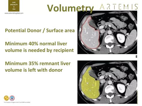 Tpct Triphasic Ct Scan Liver Ppt