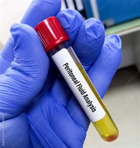 Biochemist Or Medical Technologist Hold Peritoneal Fluid Analysis