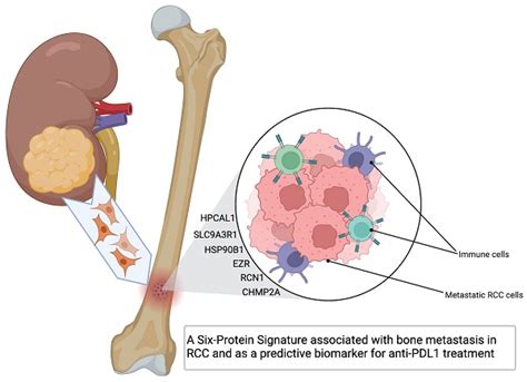 Metastatic Bone Disease Treatment