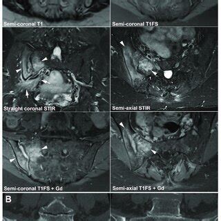 CPPD Changes In A Year Old Woman With Inflammatory Low Back And Download Scientific Diagram