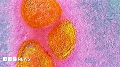 Mumps Cases See Dramatic Rise In Isle Of Man Bbc News