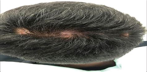 Alopecic And Aseptic Nodules Of The Scalp With Trichoscopic Indian Journal Of Dermatology