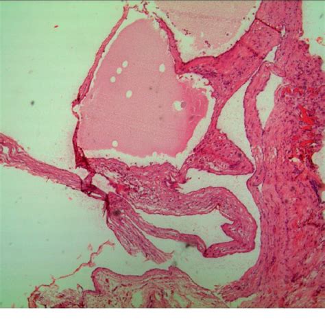 The Multicystic Mass Surrounded To Umbilicus A Greater Omentum B