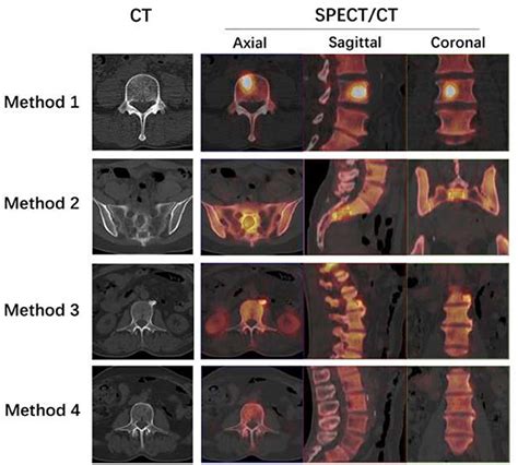 Frontiers Skeletal Standardized Uptake Values Obtained Using Quantitative Spectct For The