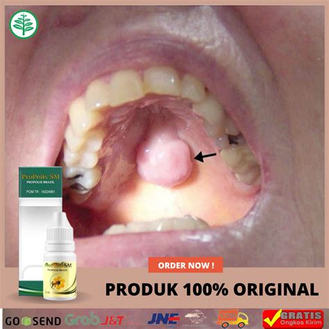 Obat Benjolan Di Langit Mulut Penghilang Benjolan Dilangit Mulut Obat Tetes Torus Palatinus