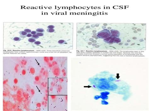 Collection Transport And Processing Of Clinical Specimens Csf Pptx