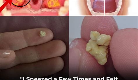 Heres What You Need To Know About Tonsil Stones