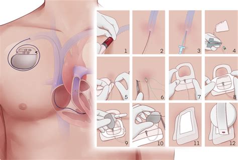 Permanent Pacemaker Reduction Using Temporary Permanent Pacemaker As A