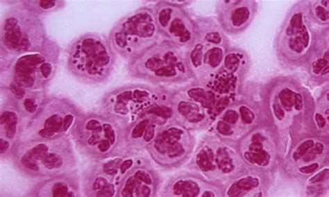 Sex Superbug Feared To Be Worse Than AIDS Discovered In Hawaii Daily Mail Online