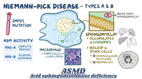 Asmd Causes Symptoms And Treatment Inherited Genetic Disorder
