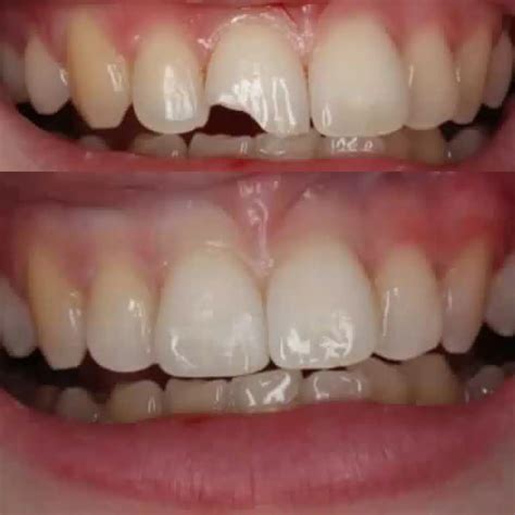 Dental Fillings In Los Algodones Mexico Dental Del Rio