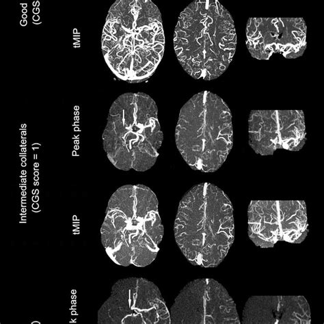 Collateral Status On Dynamic 4d Cta As Measured By Collateral Grading