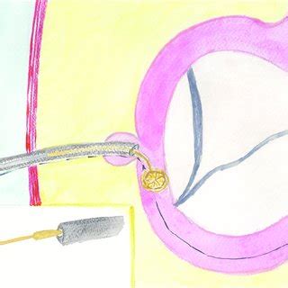 Technical Aspects For Adequate Plug Insertion The Flange Has To Be Download Scientific Diagram