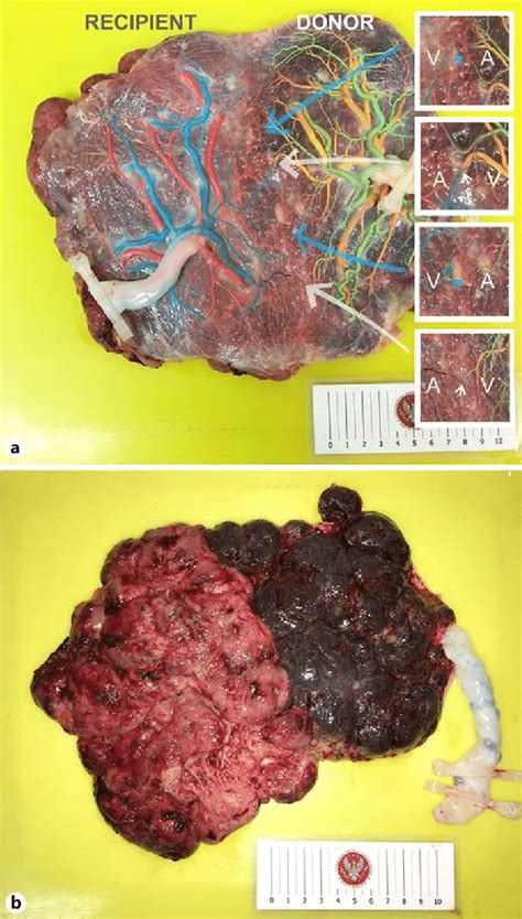 A Fetal Side Of The Placenta After Color Dye Injection Showing The Four