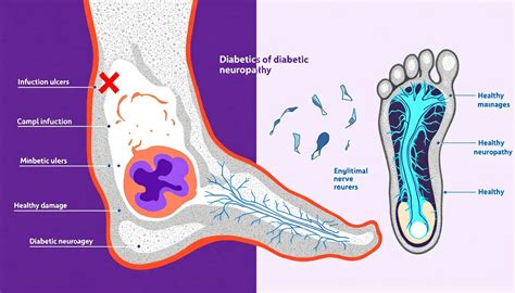 Understanding Diabetes Mellitus Neuropathy Symptoms And Management