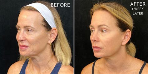Rejuvenate Your Neck Unlocking The Benefits Of Fractional Co2 Laser