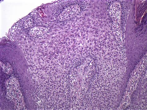Clear Cell Acanthoma Histology