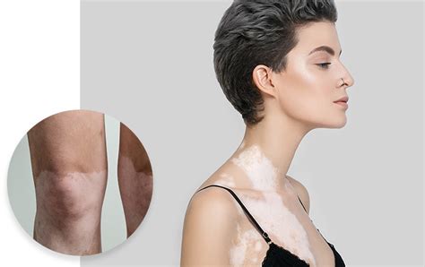 Vitiligo Treatment — Phototherapy And More Advanced Dermatology