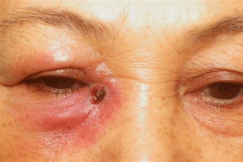 40 Facts About Mycobacterium Avium Complex Infection