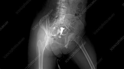 Fallopian Tube Of A Patient With Infertility X Ray Stock Image