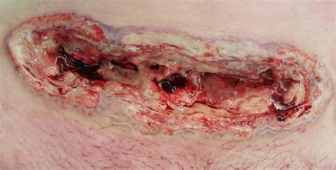 A The C Section Wound With Pustular Edges And Violaceous Borders 7th