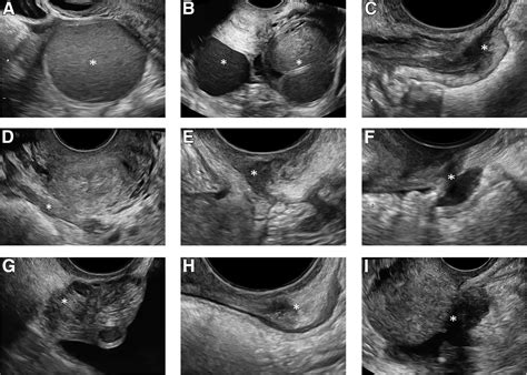 Prevalence Of Endometrioma And Deep Infiltrating Endometriosis At