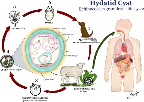 Hydatid Disease Imaging Treatment And Beyond Clinical Radiology