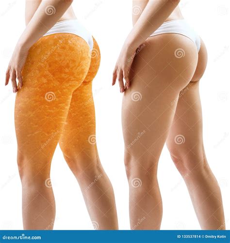Buttocks With Orange Peel Texture Before And After Tretment Stock