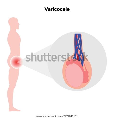Varicocele Veins Normal Veins Male Disease Stock Vector Royalty Free