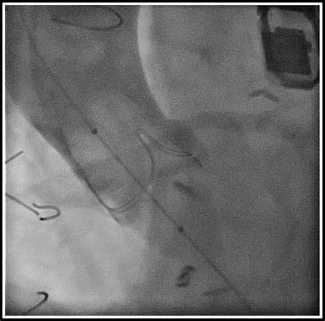 Aortic Root Angiography During Balloon Valvuloplasty With 1 2
