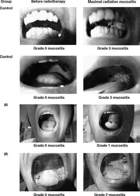 Photographs Illustrating Radiation Induced Mucositis And The Effect Of