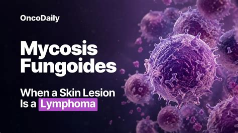 Mycosis Fungoides Mf Symptoms Diagnosis Treatment And Where