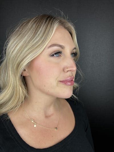 Chin Filler Before And After Photos Pēkomd®