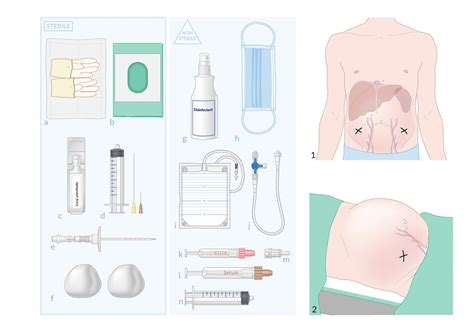 Paracentesis Equipment Best Practices Paracentesis