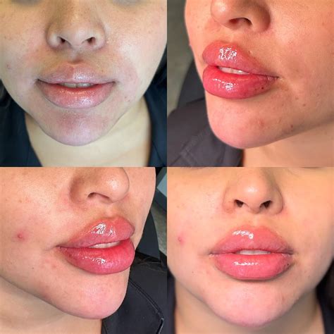 Patient 146737646 Lip Fillers Before And After Photos Dr Courtney