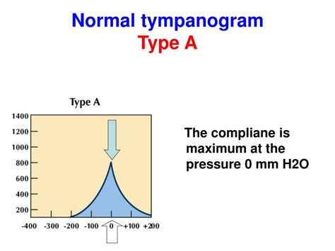 Type C Tympanogram Causes At Mickey Munos Blog Type C Tympanogram Causes At Mickey Munos Blog