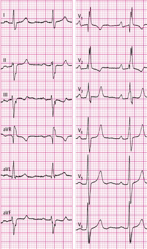 Normal Sinus Rhythm With Right Bundle Branch Block Discount
